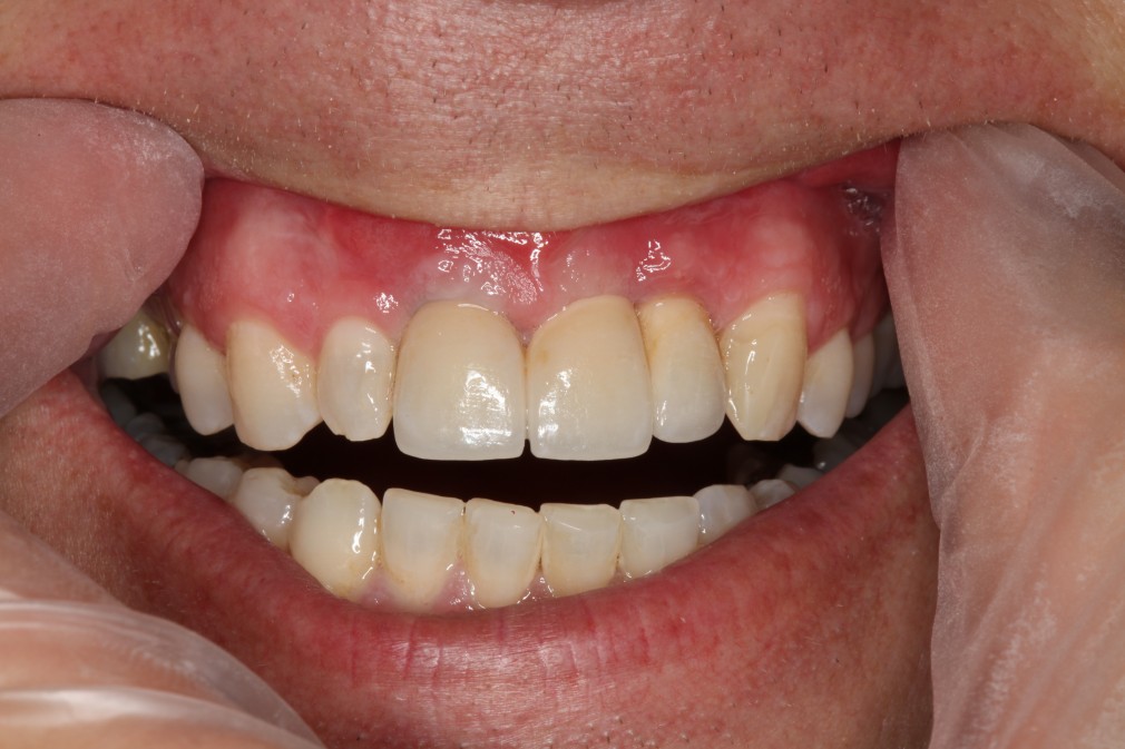 Additional Cases - Mueller's Dental Arts Laboratory